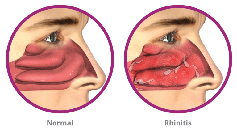 RhinAer® Treatment New York NY - Chronic Rhinitis NYC
